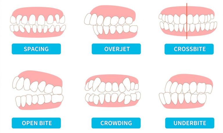 Types of Malocclusions: Causes, Symptoms & Treatments
