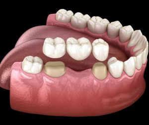 Missing Back Tooth? 3 Solutions for Back Teeth Replacement