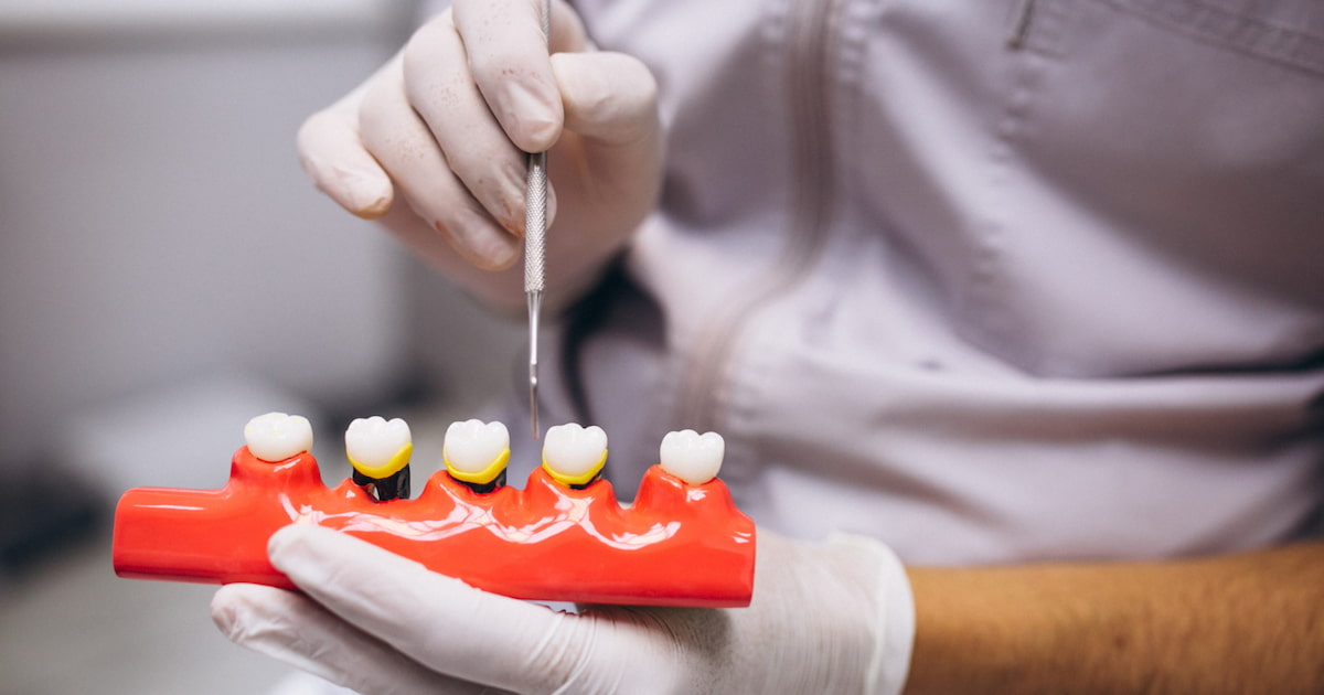 How to Fix a Broken Dental Crown: Step-by-Step Guide