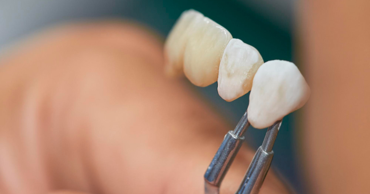 Best Materials for Dental Crowns: Porcelain, Zirconia & More