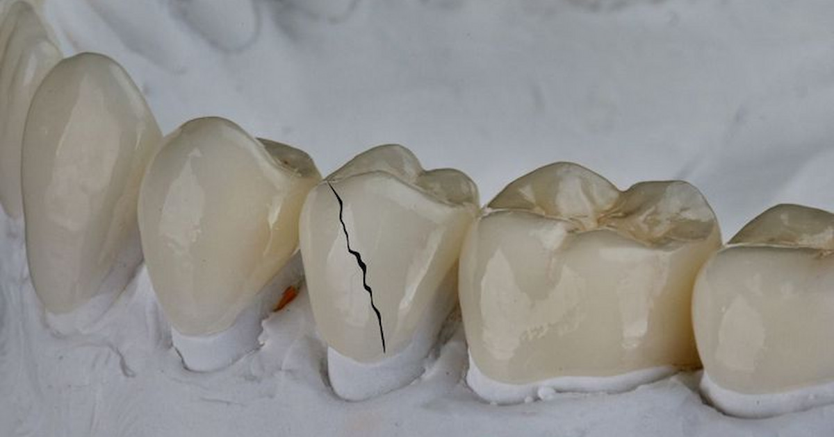 Front Tooth Crown: Benefits, Costs, and Care Tips Explained