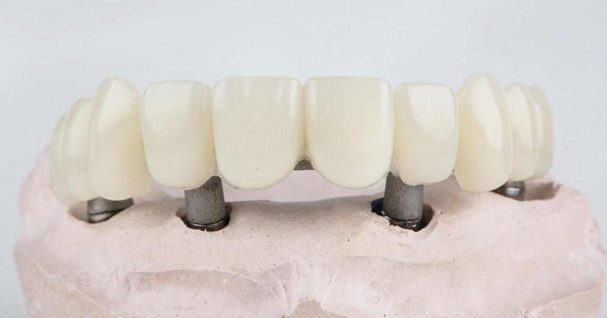 Single vs. Full-Arch Dental Implants: A Complete Guide