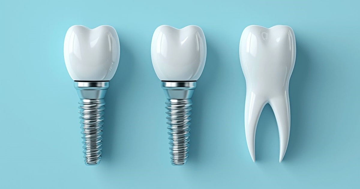 Types of Dental Implants: What You Need to Know