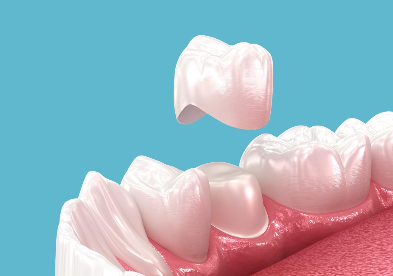 What is Dental Crown Open Margin and What are the Treatments